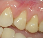 Before and After Photos in Stuart, FL | Stuart Periodontics