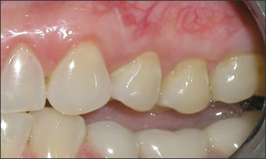 AlloDerm® Gum Grafting in Stuart FL | Stuart Periodontics